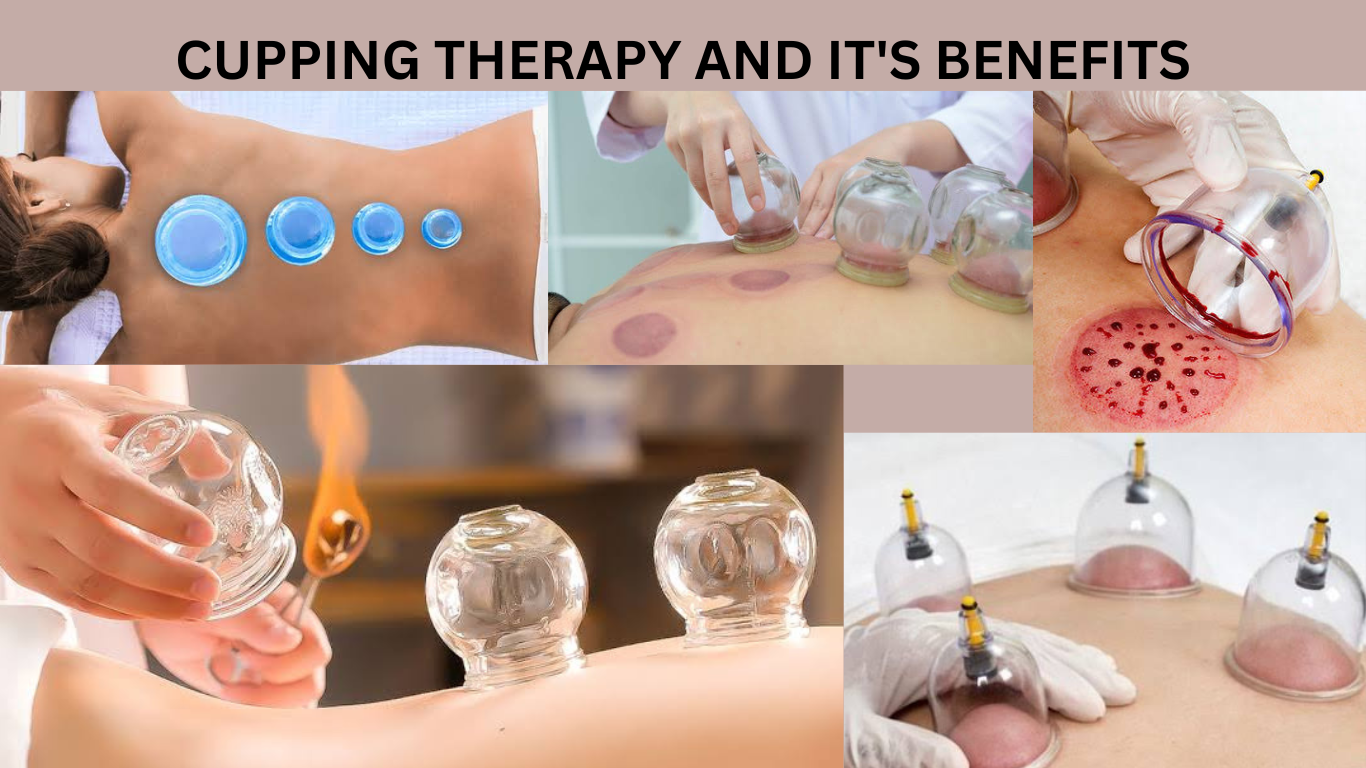 Cupping Therapy And Its Benefits Physiofitfinder Cupping Therapy And Its Benefits Physiofitfinder